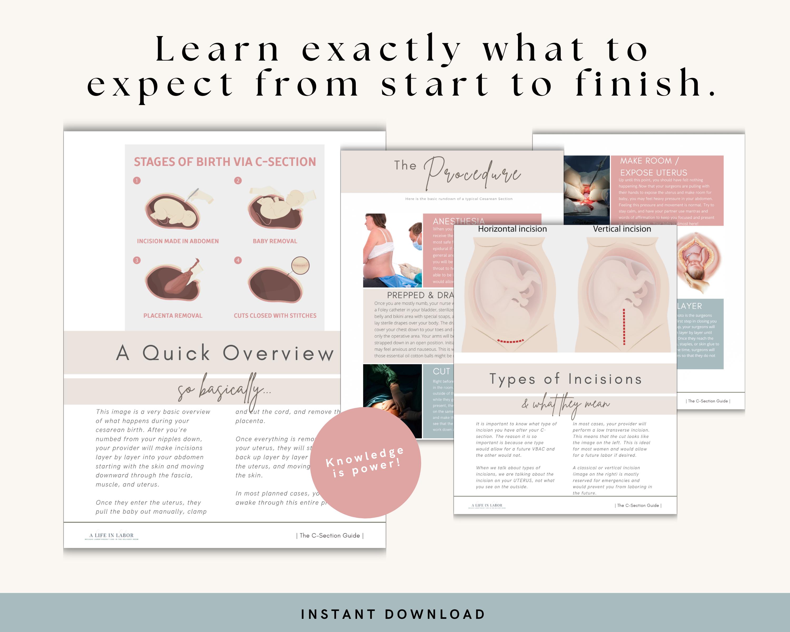 C-section Birth Guide | Empowering Cesarean Recovery & Preparation | In ...