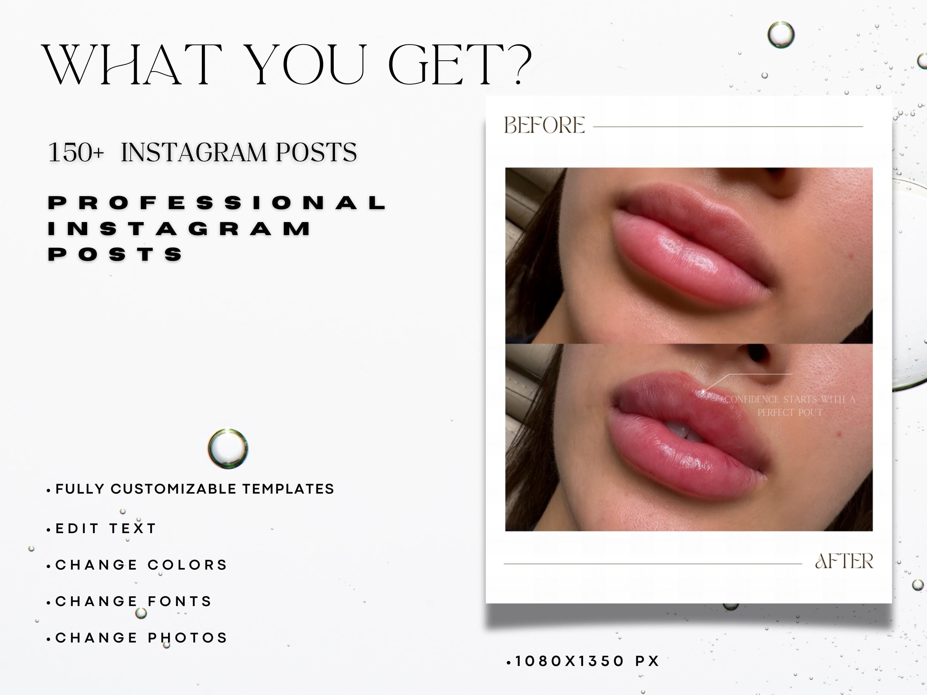Lip Filler Before & After Instagram Templates: Medspa Social Media ...