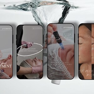 Microneedling Instagram Reels Bundle | RF & Facial Treatment Video ...