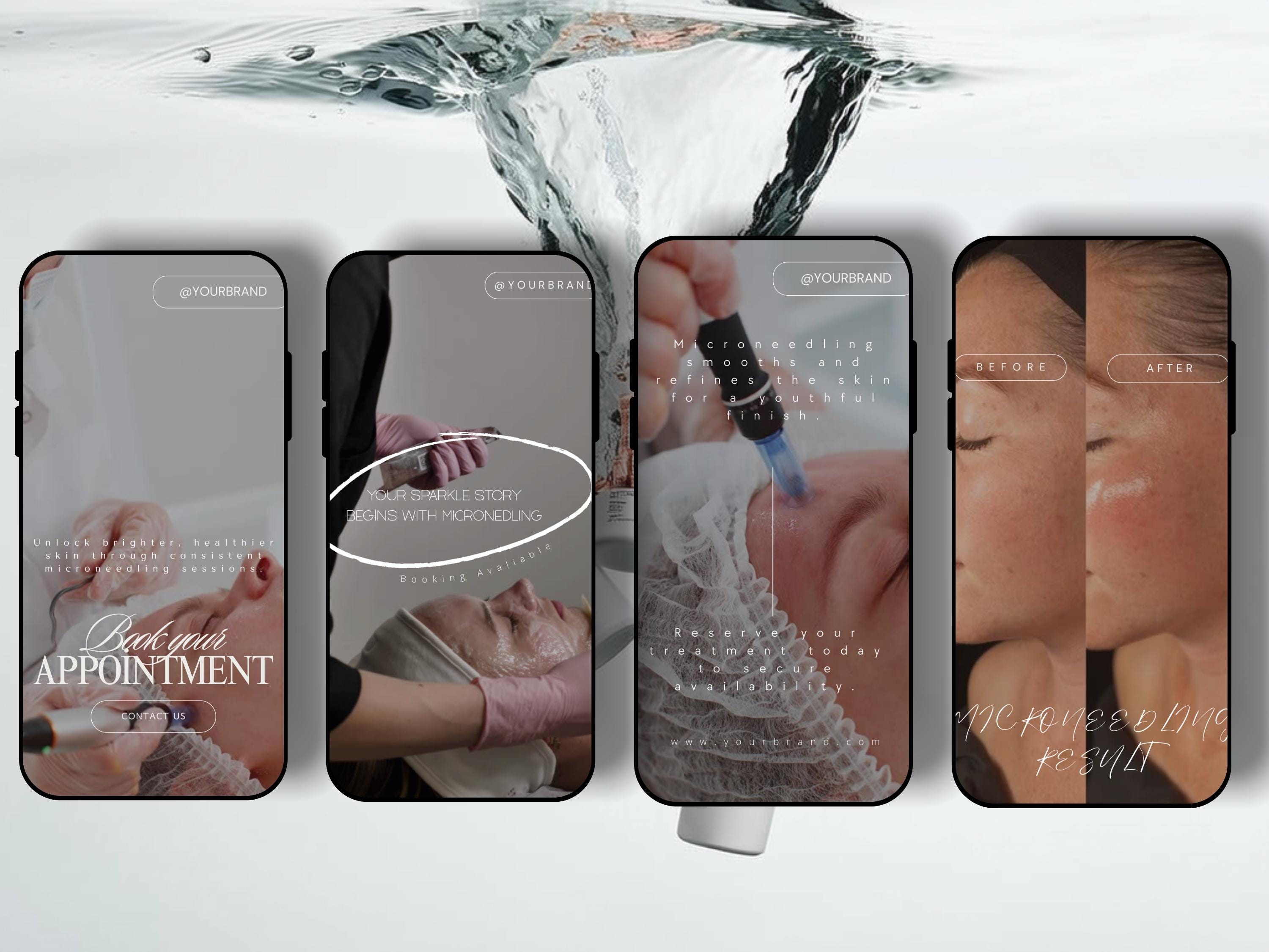 Microneedling Instagram Reels Bundle | RF & Facial Treatment Video ...