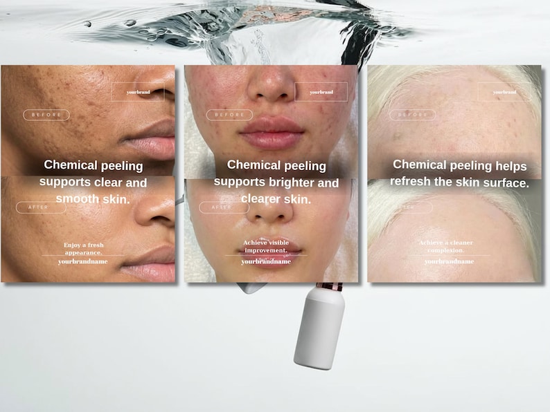 Before After Chemical Peel Canva Template | Med Spa & Skin Care Clinic ...