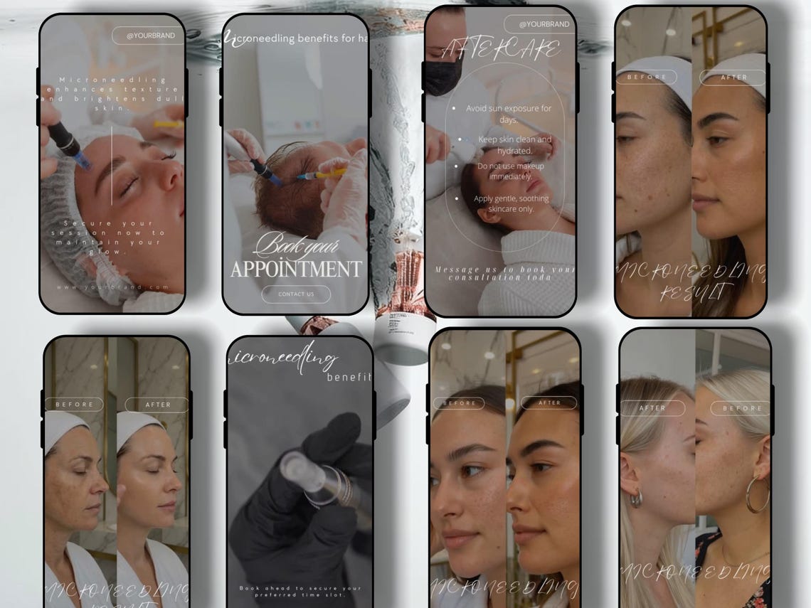 Microneedling Instagram Reels Bundle | RF & Facial Treatment Video ...