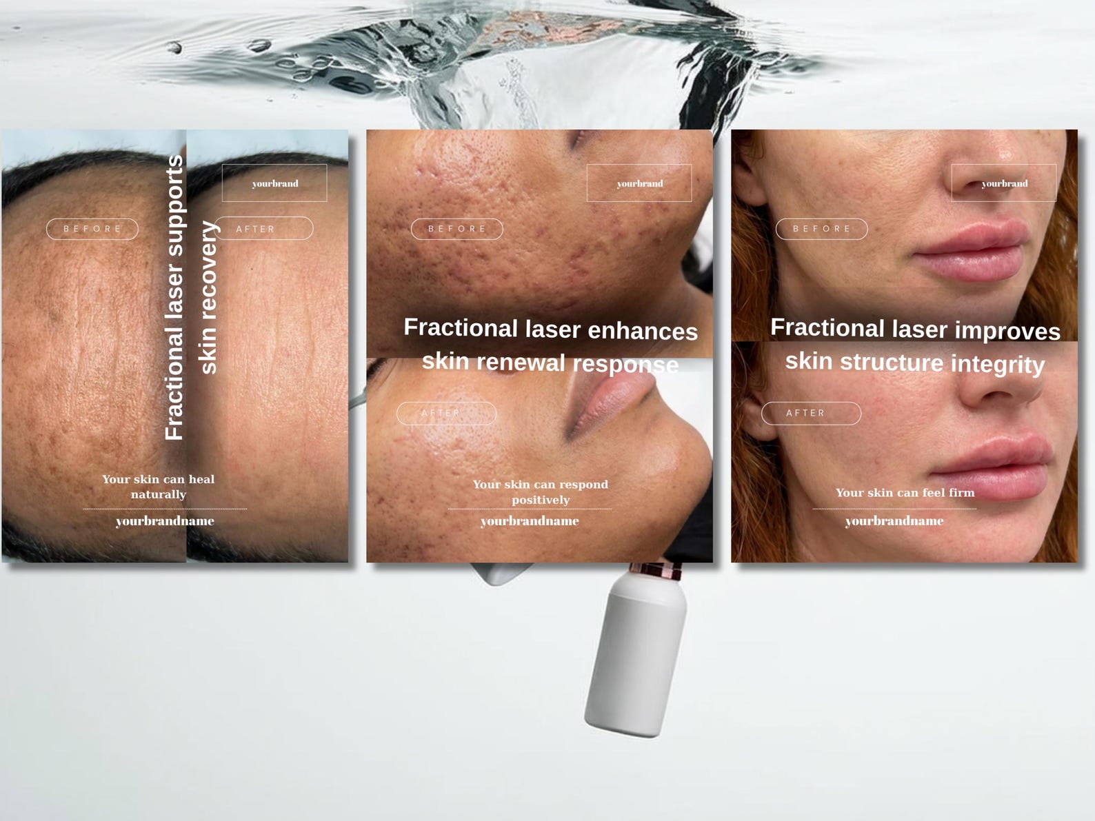 Fractional Laser Instagram Templates – Editable Canva Digital Download ...
