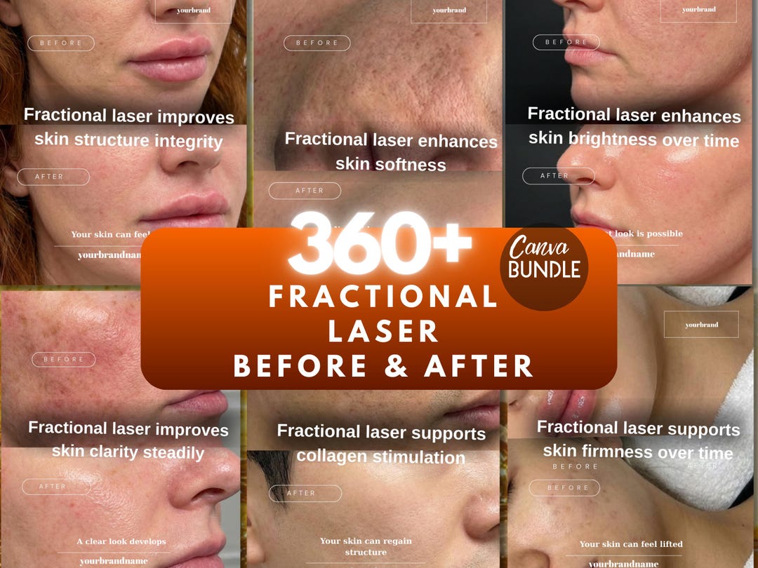 Fractional Laser Instagram Templates – Editable Canva Digital Download ...
