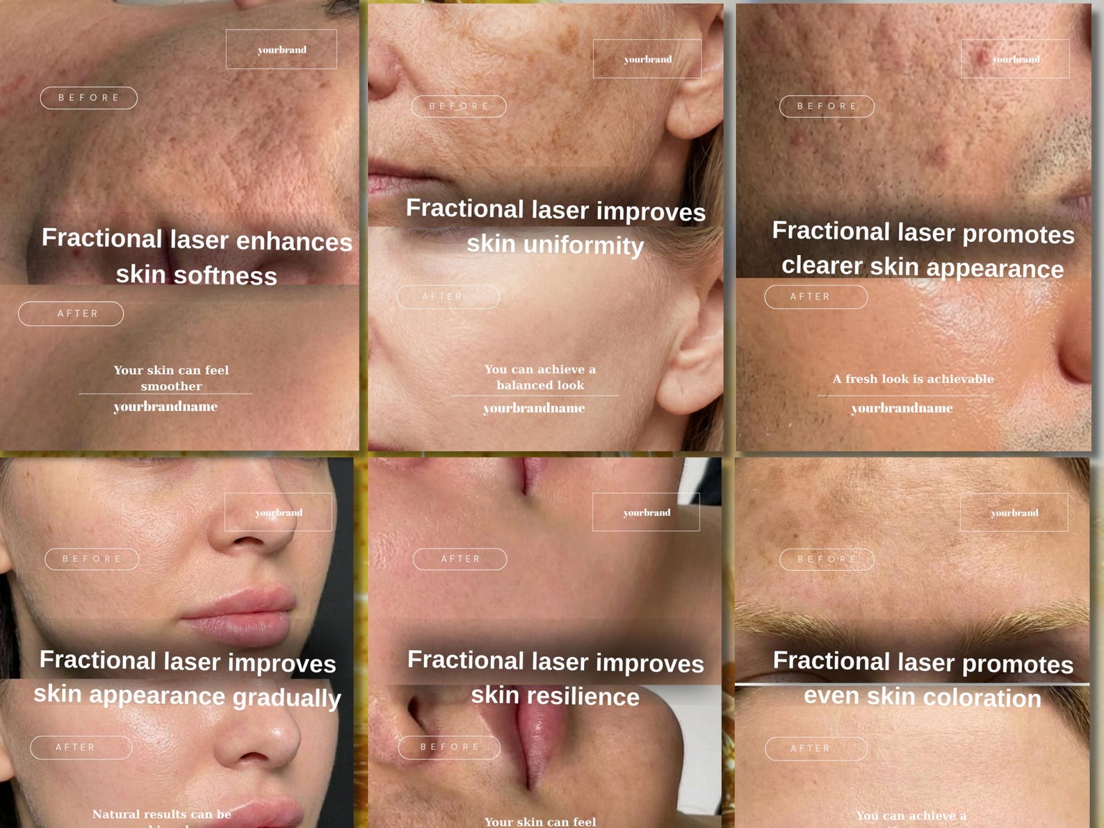 Fractional Laser Instagram Templates – Editable Canva Digital Download ...