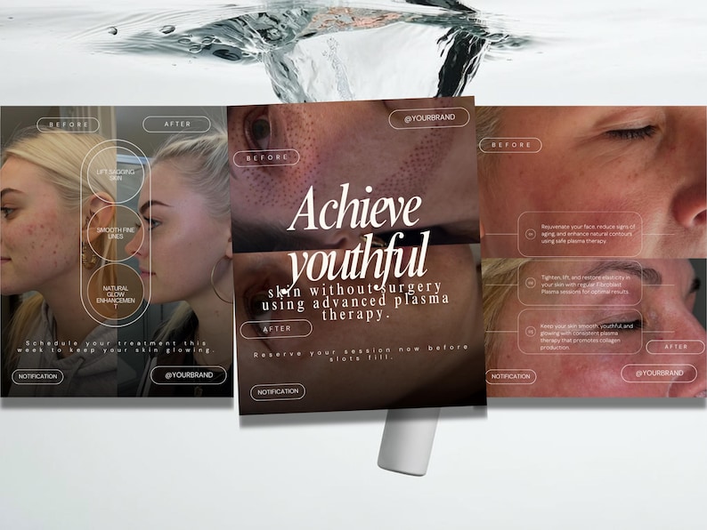Plasma Pen Fibroblast Templates | Clinic Canva Templates | Beauty ...