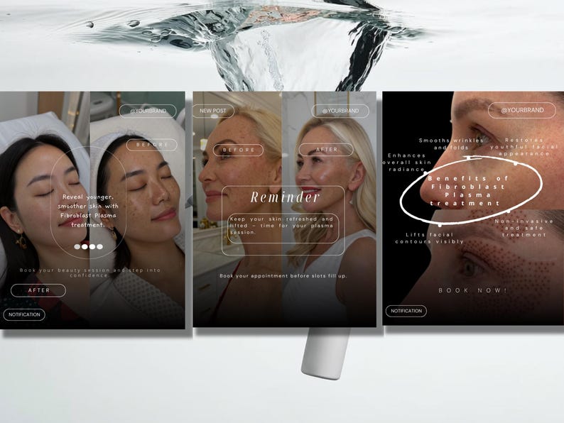 Plasma Pen Fibroblast Templates | Clinic Canva Templates | Beauty ...