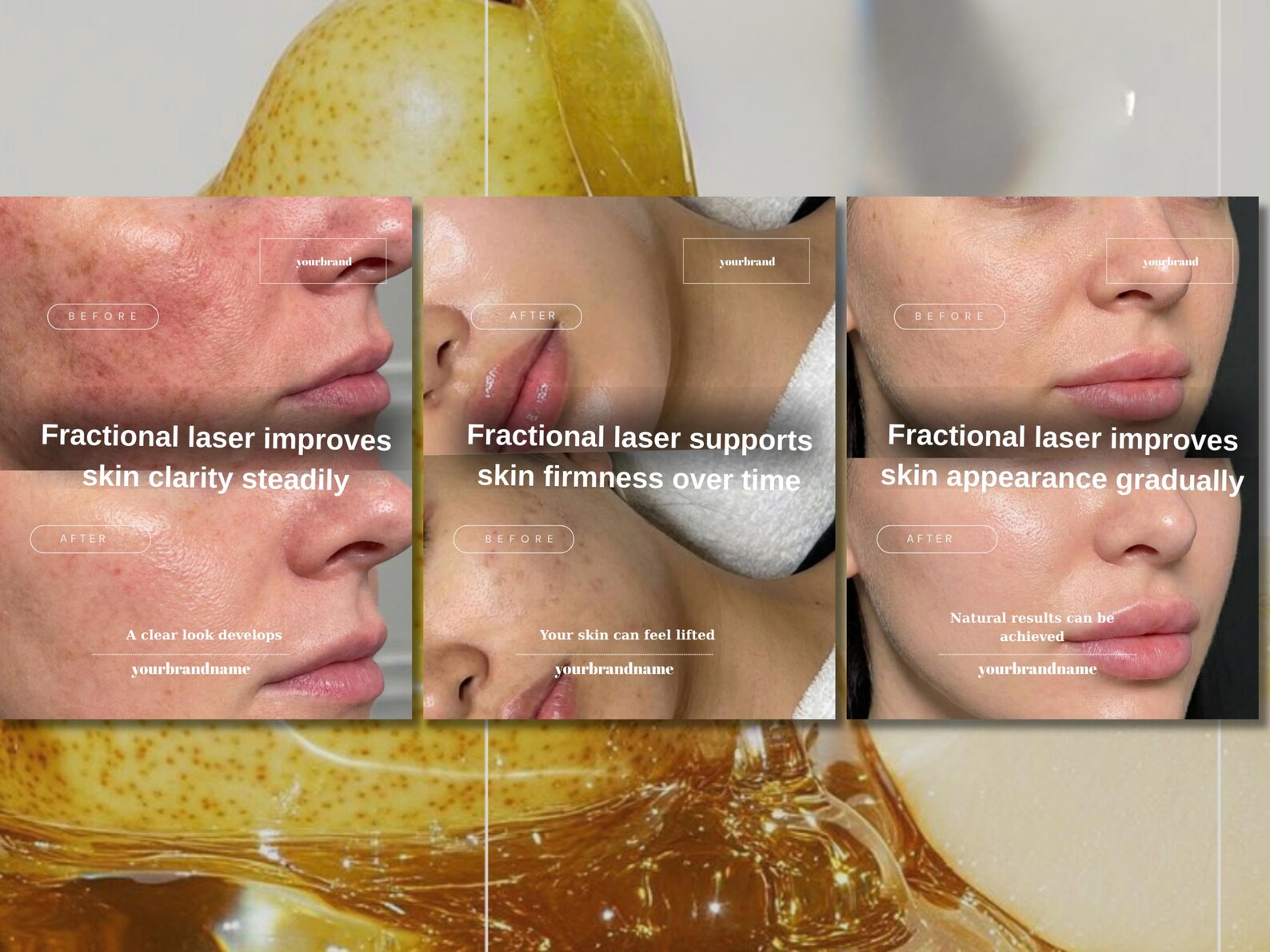 Fractional Laser Instagram Templates – Editable Canva Digital Download ...
