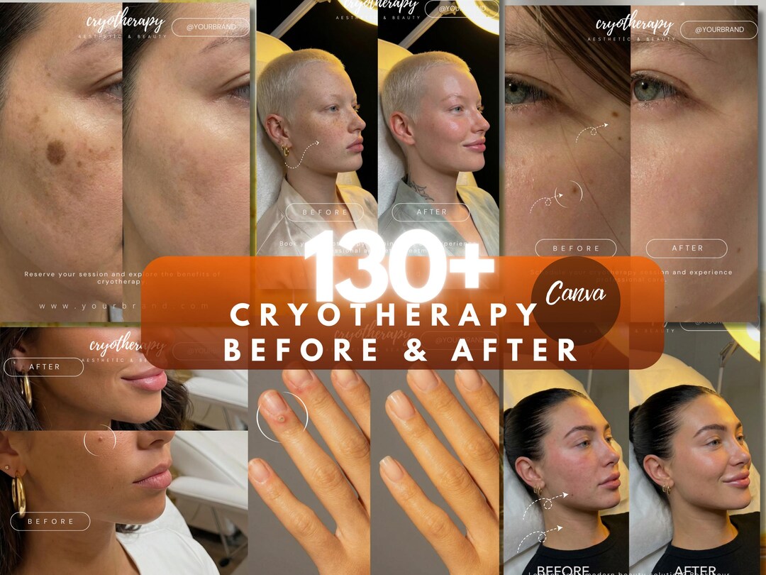 Cryotherapy Canva Template | Editable Instagram Post for Med Spa | Body ...