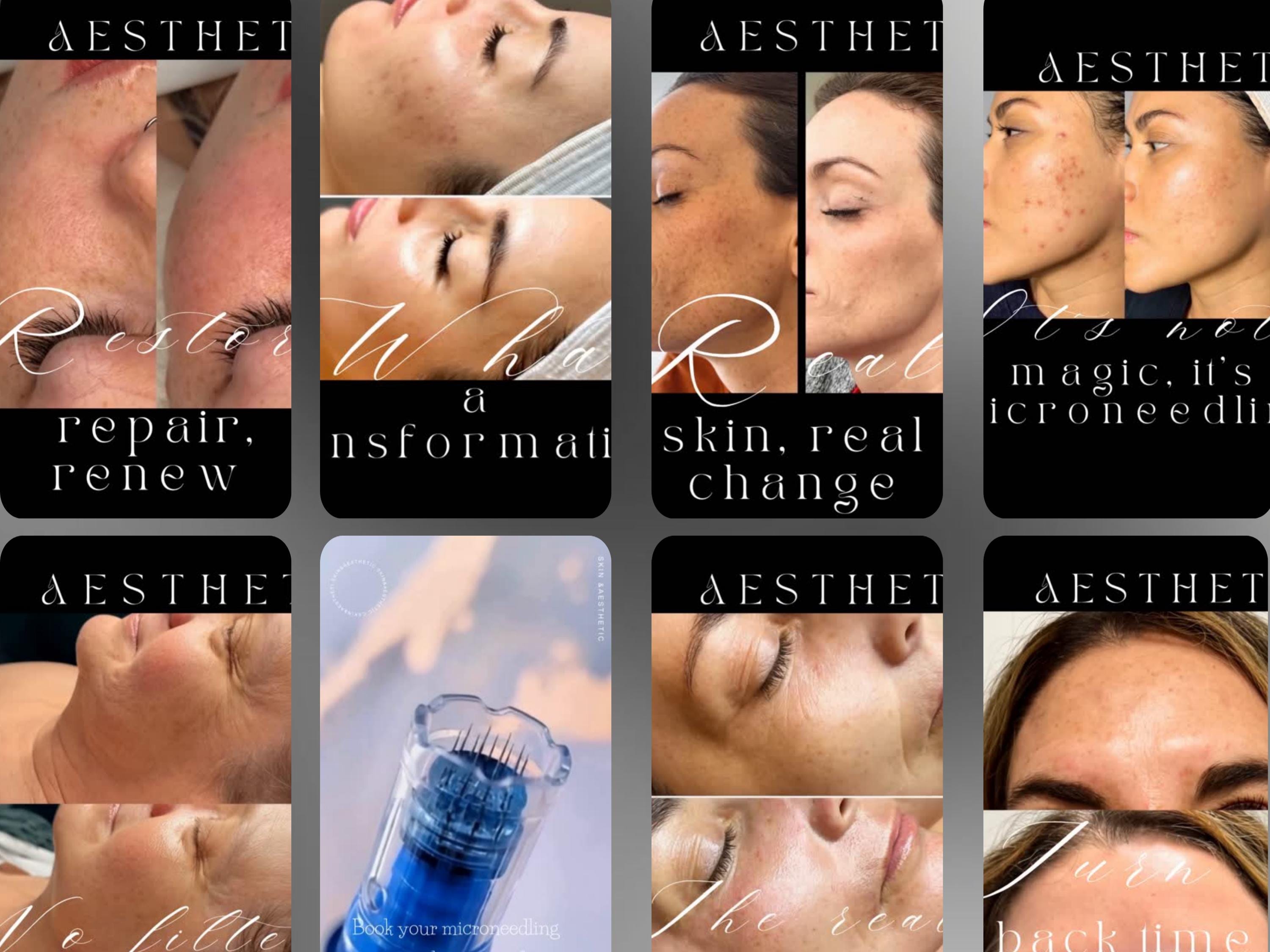 Microneedling Before After Video Reels,skin Needling,facial Treatment ...