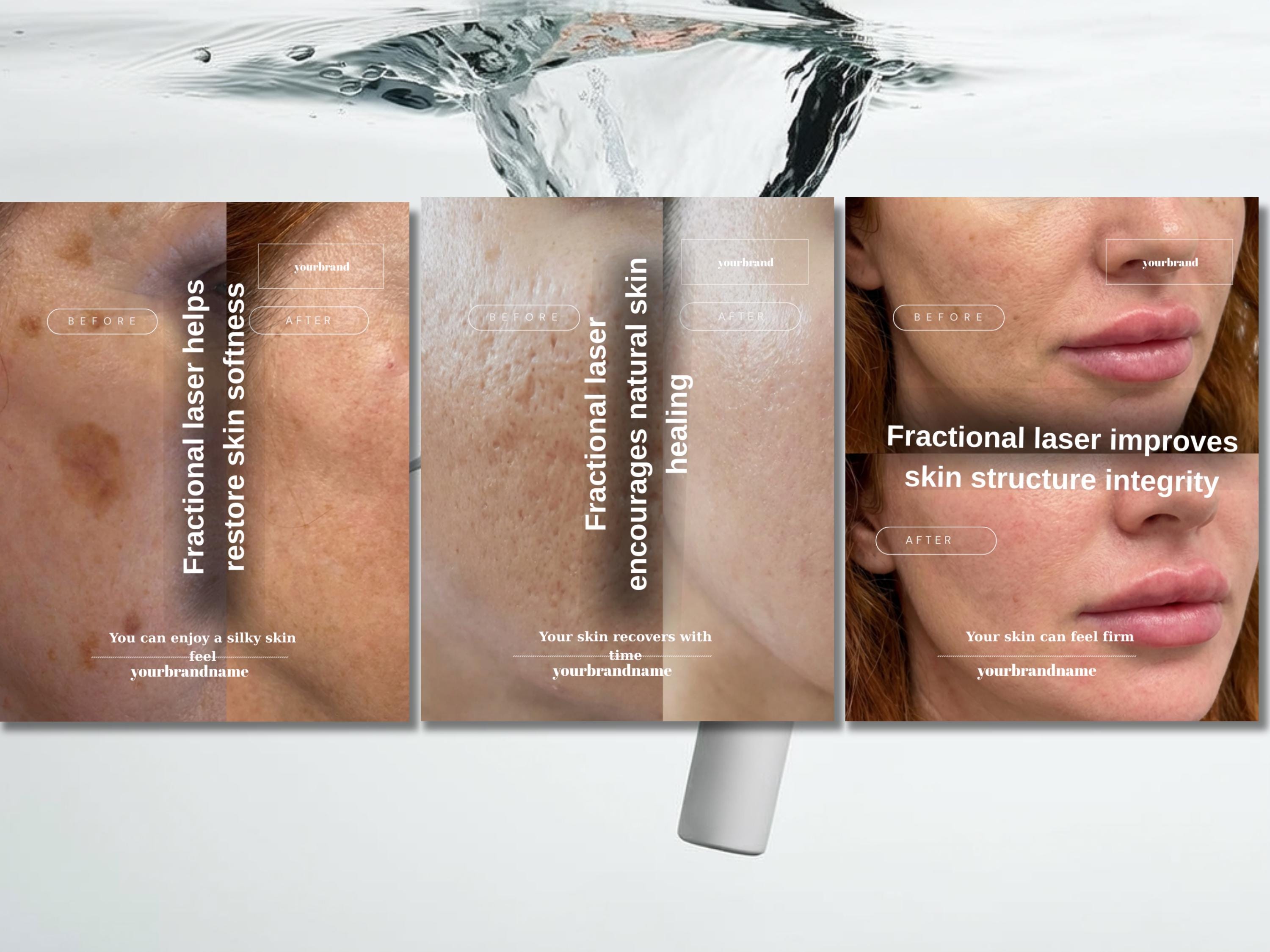Fractional Laser Instagram Templates – Editable Canva Digital Download ...