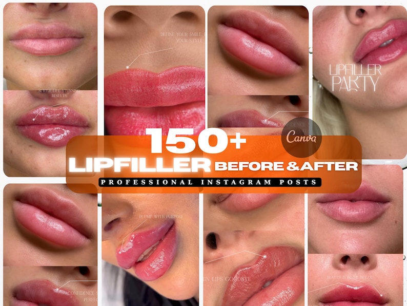 Lip Filler Before After Post | Lip Injection Before and After, Skincare | Lip Filler Result ...