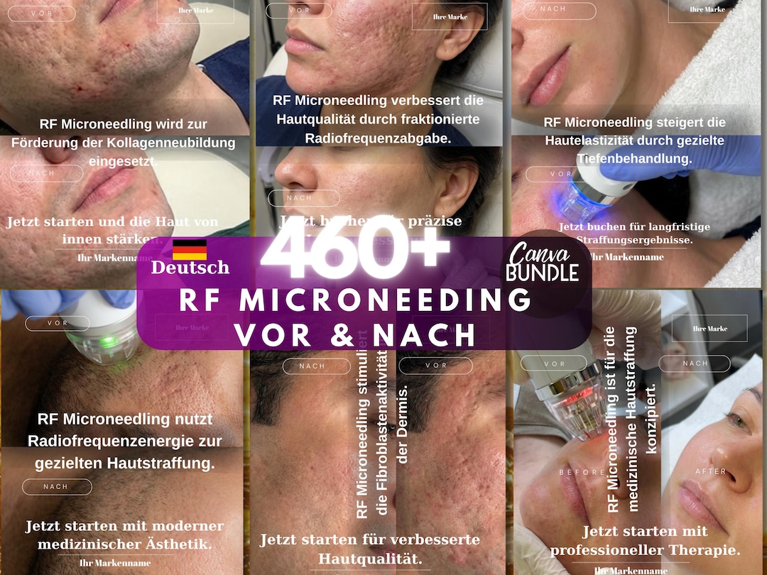 Microneedling Tranensacke Vorher Nachher
