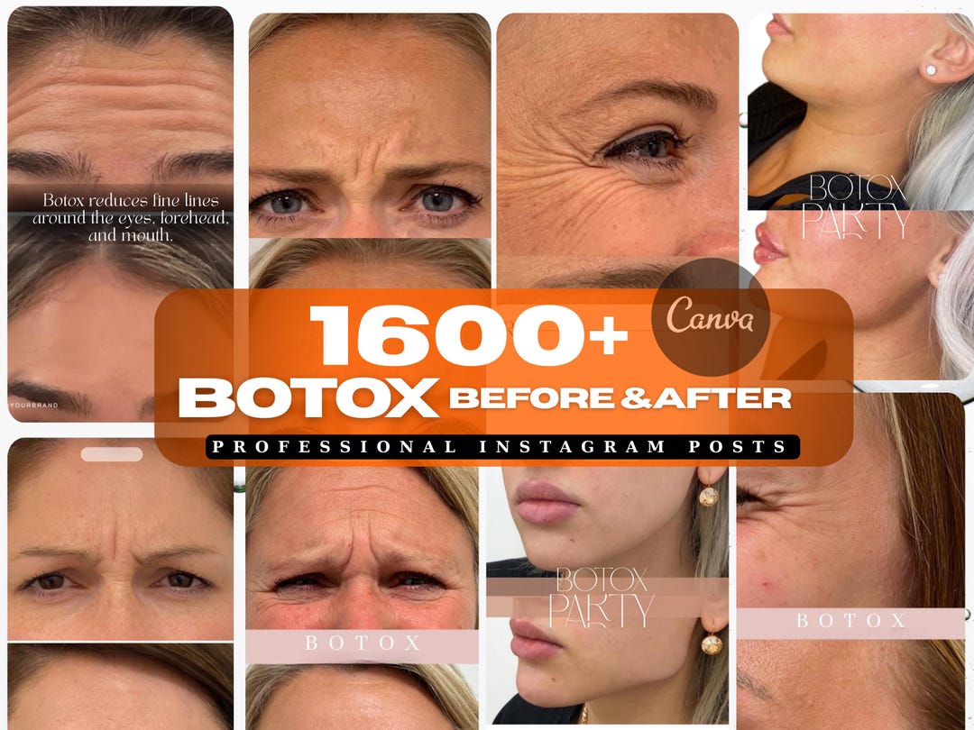 Botox Instagram Post Templates: Medspa Social Media (1600+ Canva) - Etsy UK