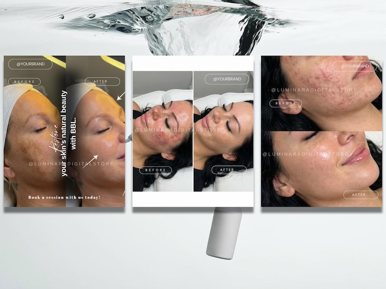 BBL Laser Canva Template, Med Spa Treatment Tracker, Esthetician ...