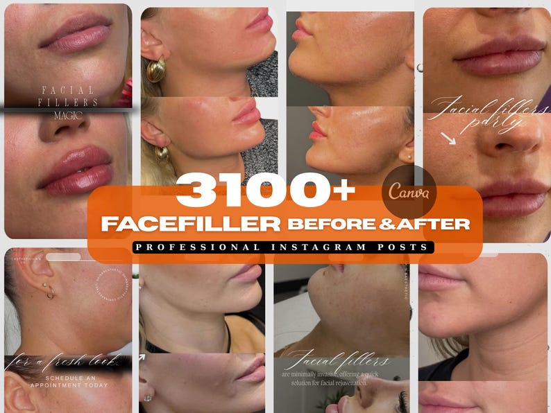Facial Filler Before After Post,filler Result, Dermalfiller, Lip Filler ...
