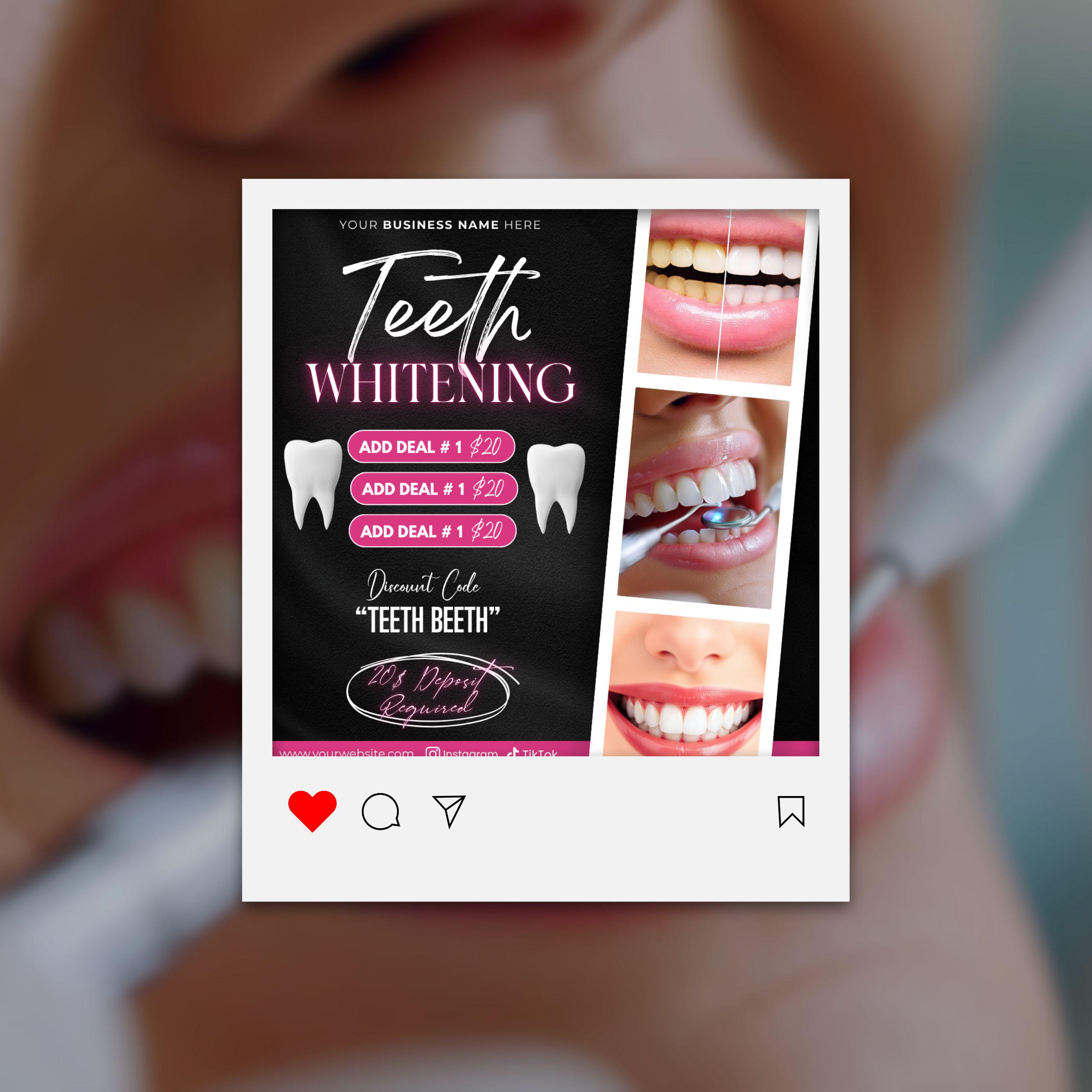 Teeth Whitening Flyer, Teeth Whitening Post, Teeth Whitening Marketing ...