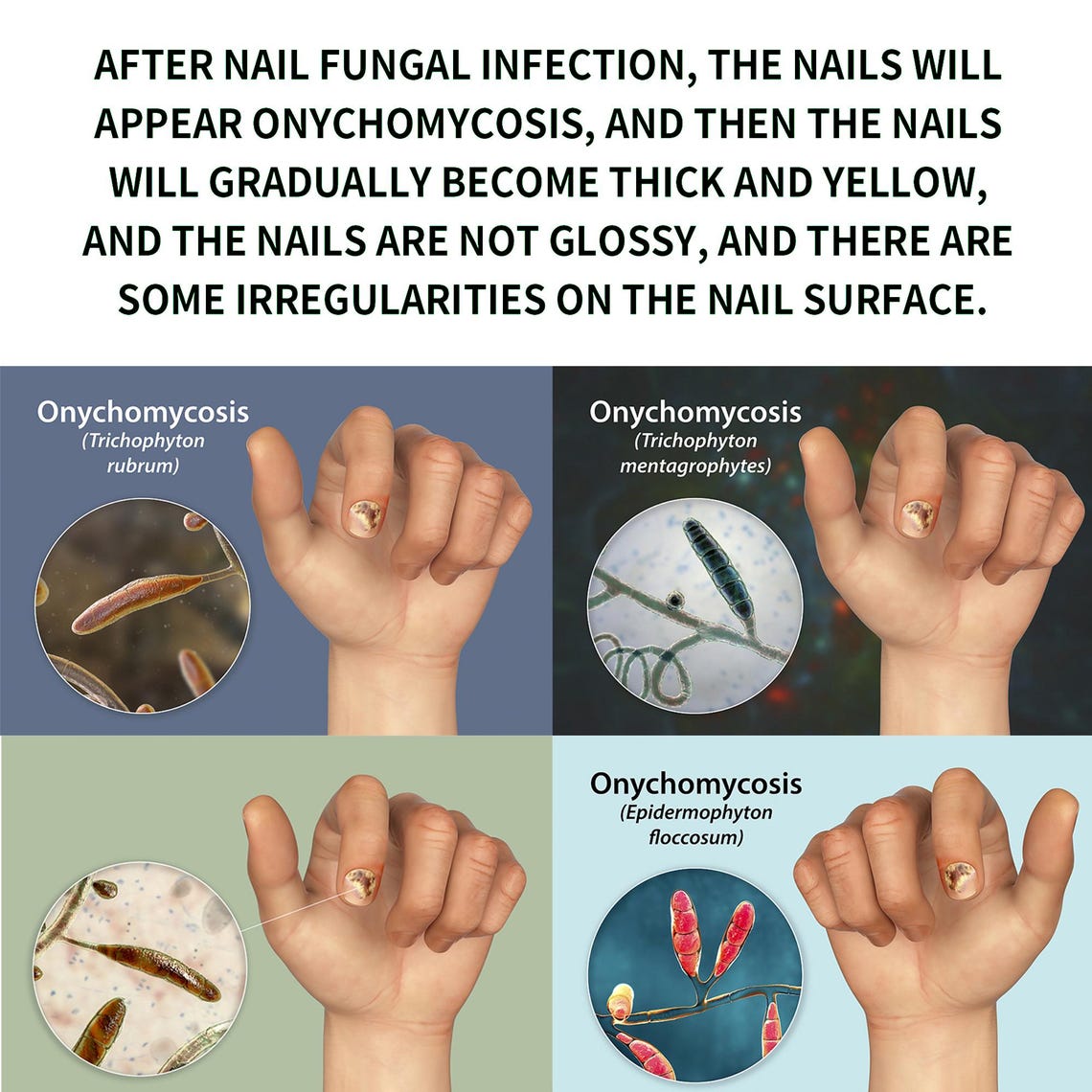 Nail Fungus Treatment,toe and Fingernail Solution,soften Thick Nails ...