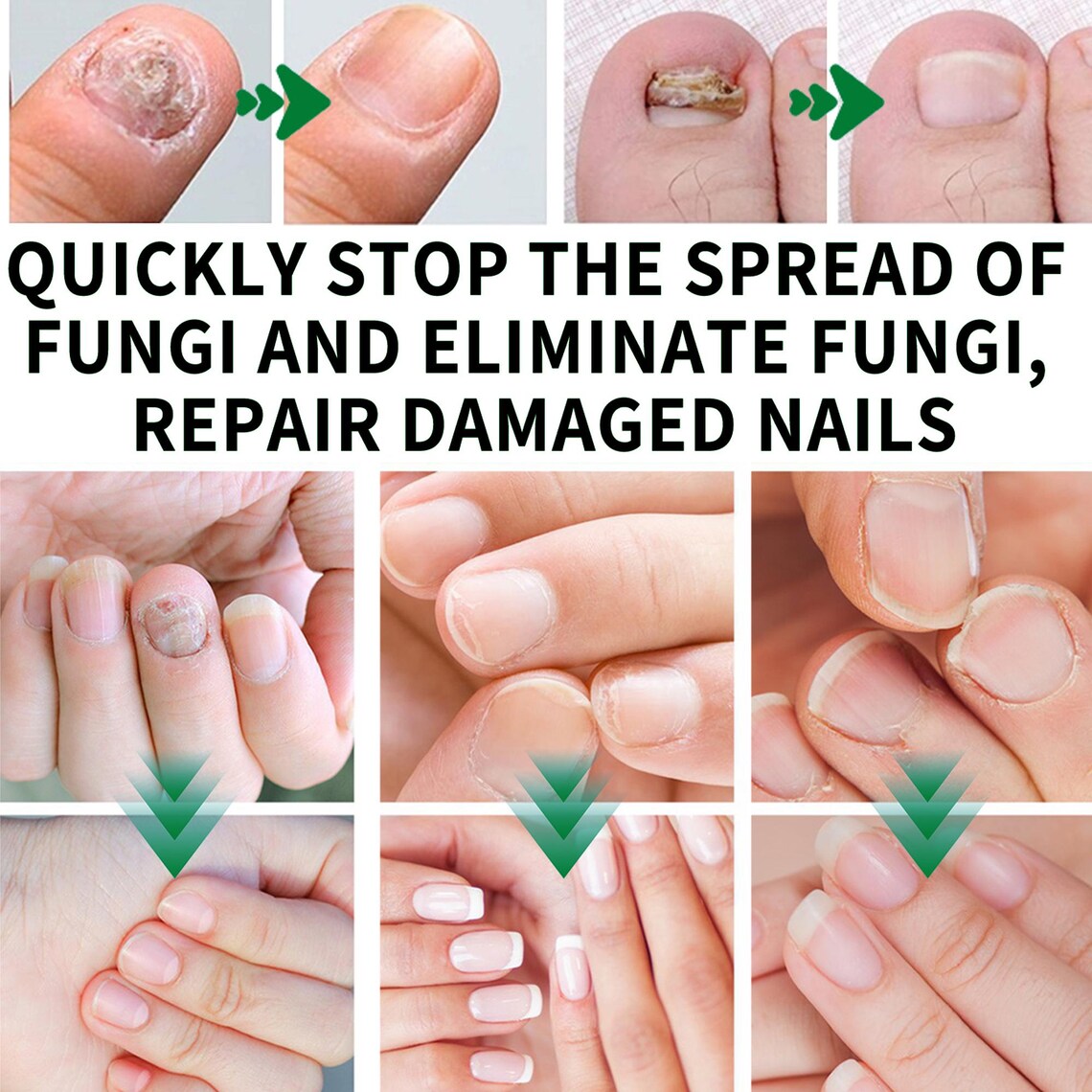 Nail Fungus Treatment,toe and Fingernail Solution,soften Thick Nails ...