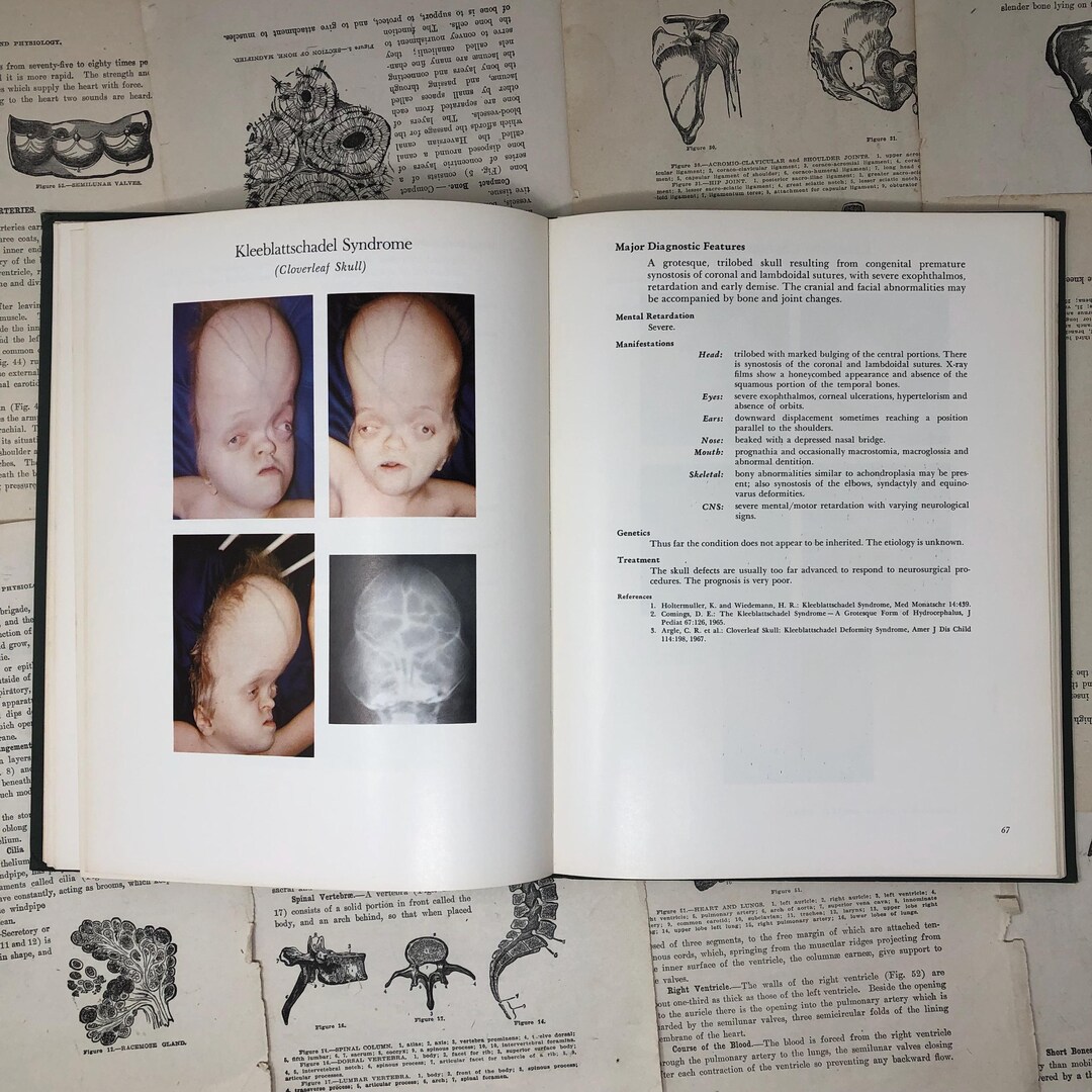 1960s Atlas of Mental Retardation Syndromes US Dept of Health Medical ...