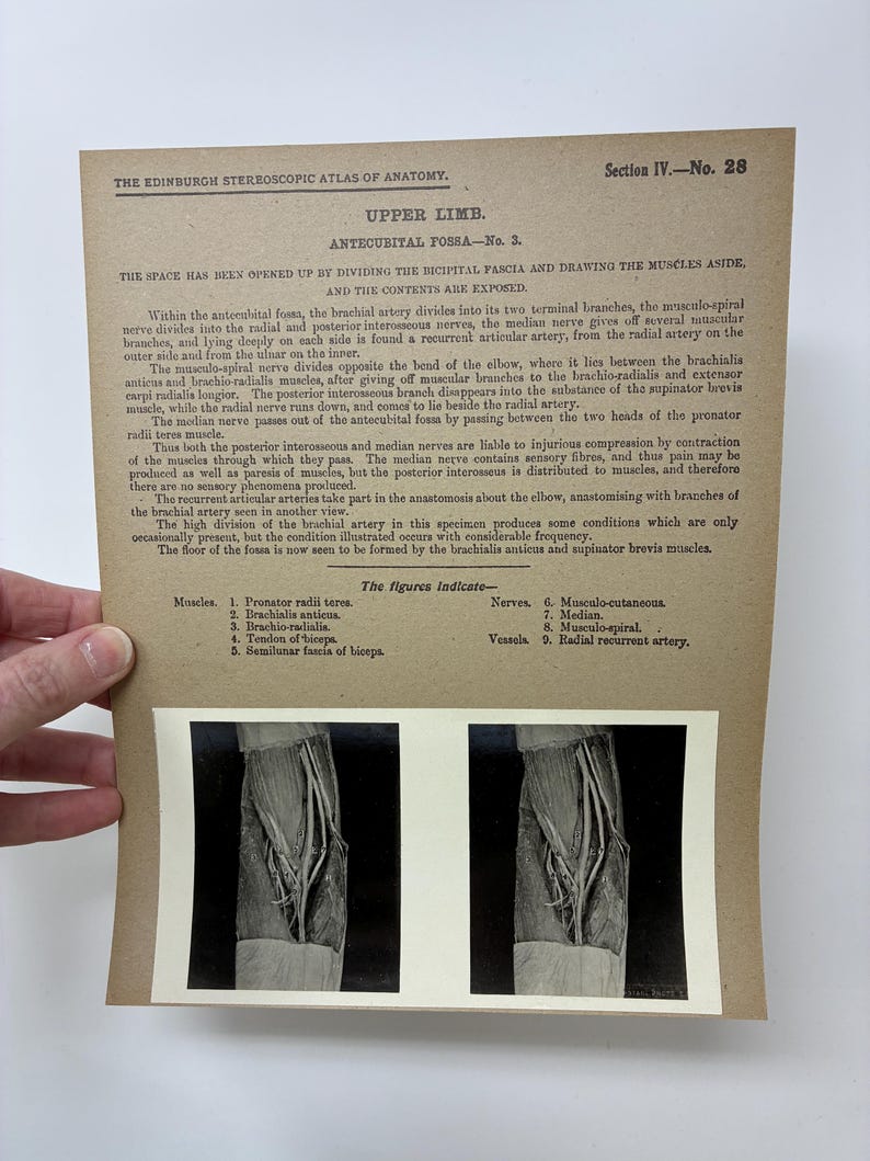 1905 Human Arm Dissection Medical Stereoview Card - Upper Limb ...