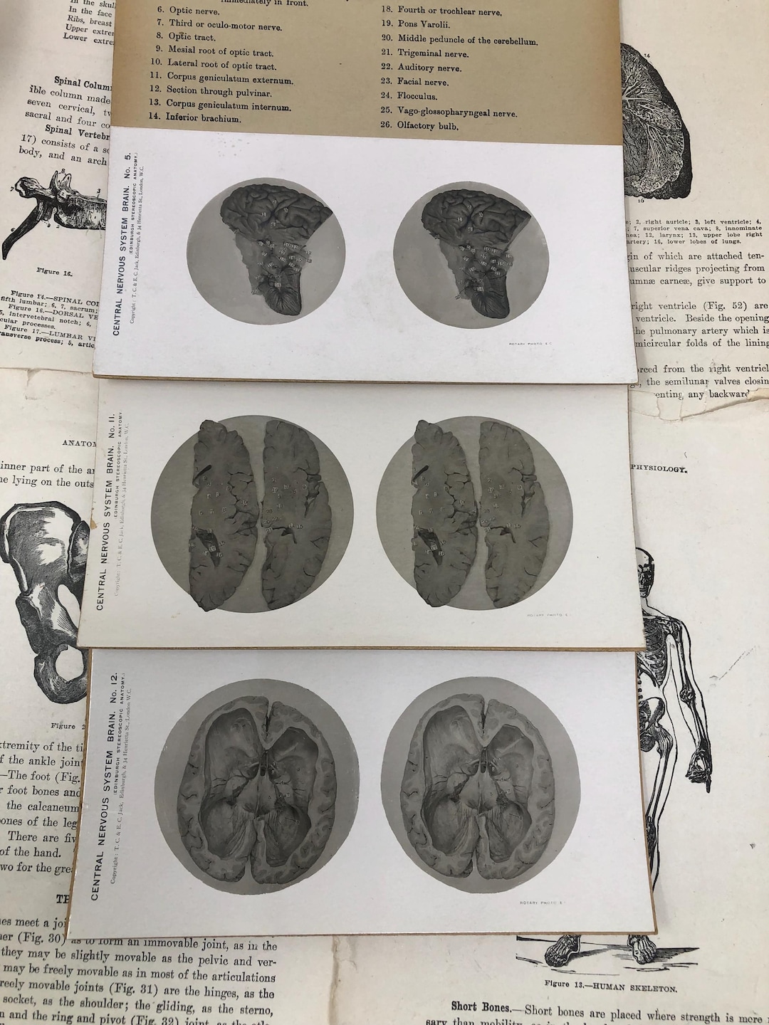 YOU PICK! 1905 Human Brain Dissection Medical Stereoview Card - Central ...