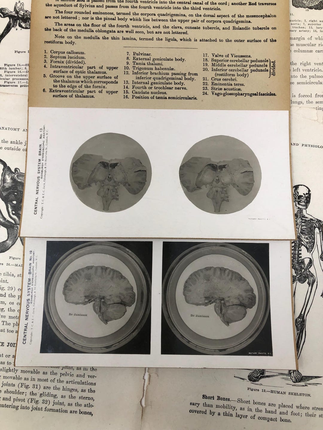YOU PICK 1905 Human Brain Dissection Medical Stereoview Card Central ...