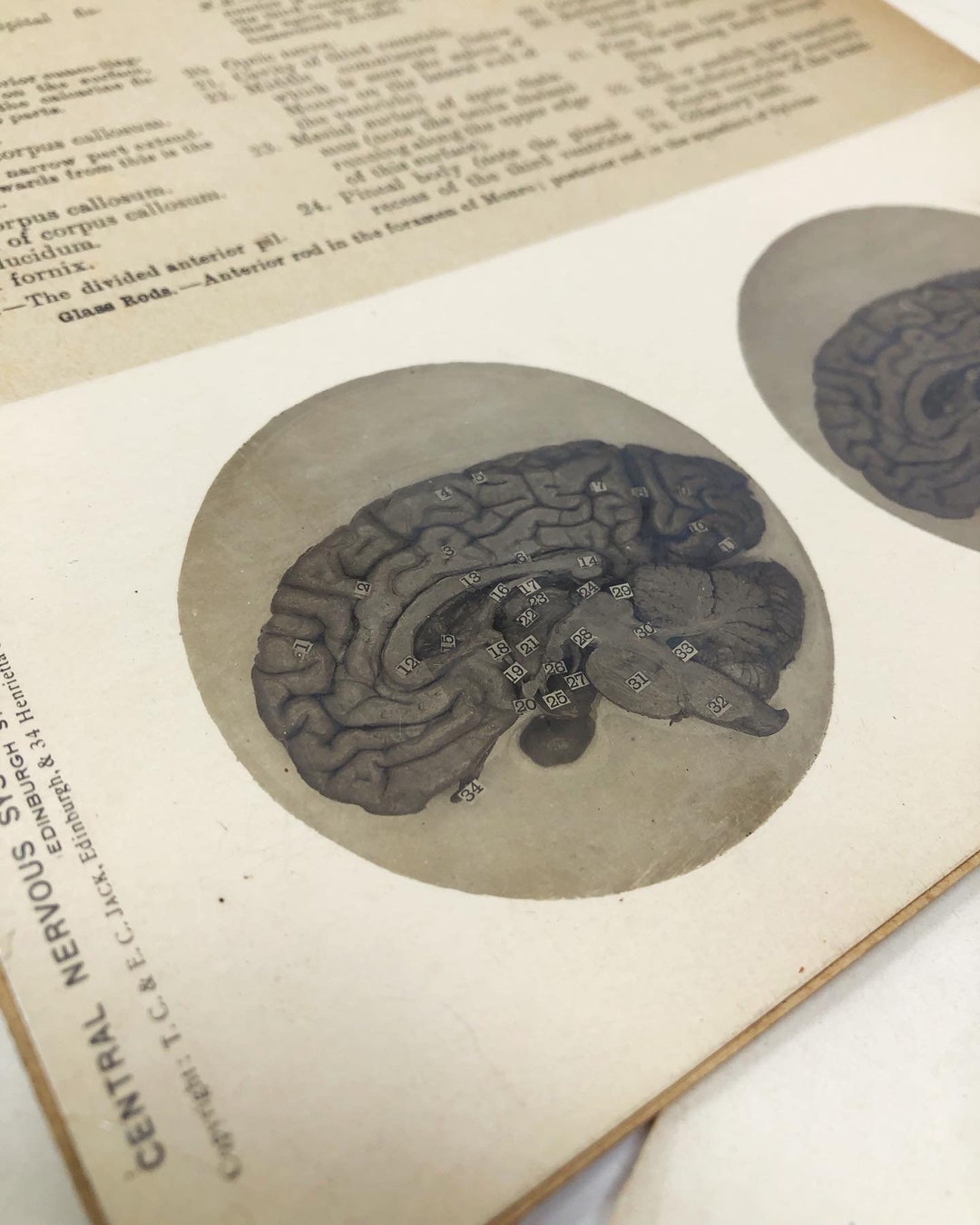 1905 Human Brain Dissection Medical Stereoview Card - Central Nervous ...