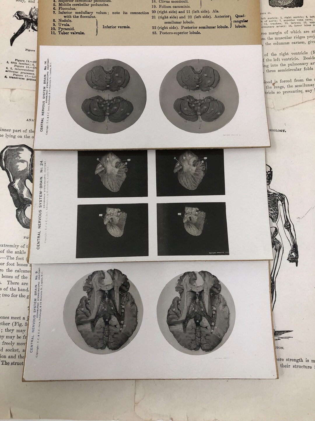 YOU PICK! 1905 Human Brain Dissection Medical Stereoview Card - Central ...