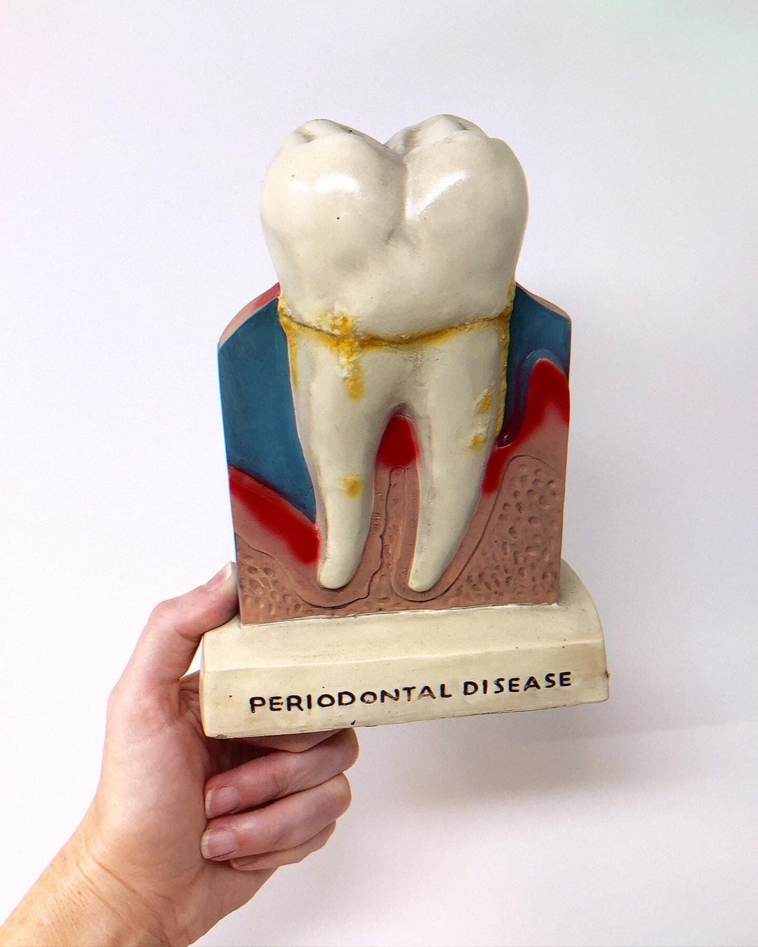 Big Tooth Model Advertising Dental Decay Molar - Dentist Office ...