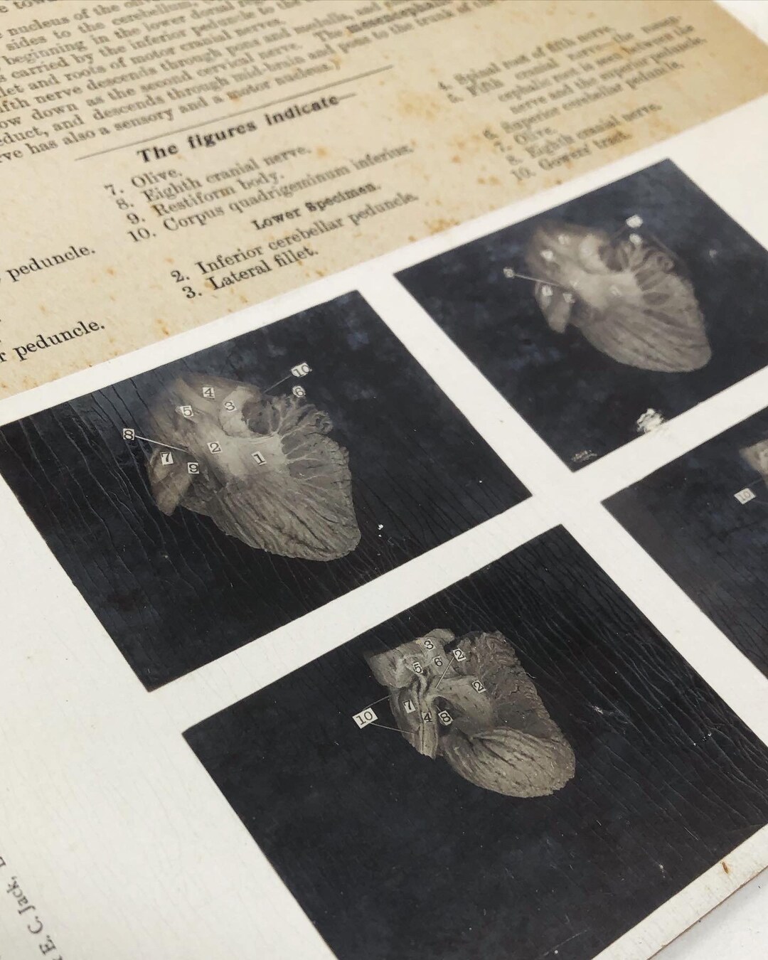 1905 Human Brain Dissection Medical Stereoview Card - Central Nervous ...