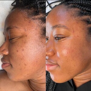 Affordable Skincare Routine Ebook for Acne-prone & Oily Skin – Clear ...