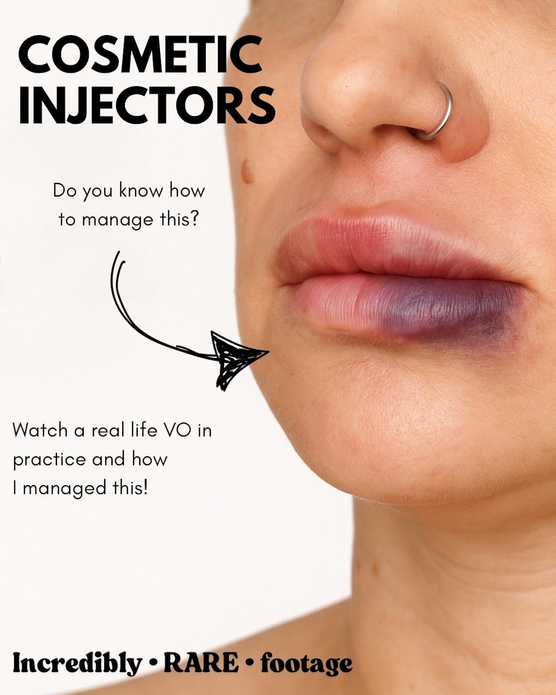 Module ONE: Lip Filler + Vascular Occlusion Management - Etsy
