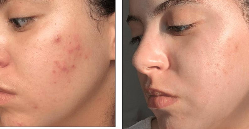 Acne Cream Pimples Effective Acne Spot Clear Skin Scar Cream Overnight ...