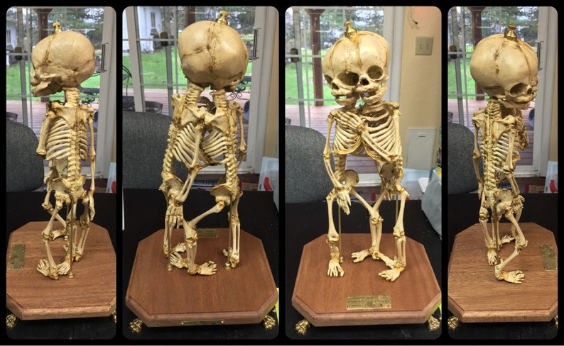 SALE Conjoined Twins Siamese Fetal Skeletons - Etsy