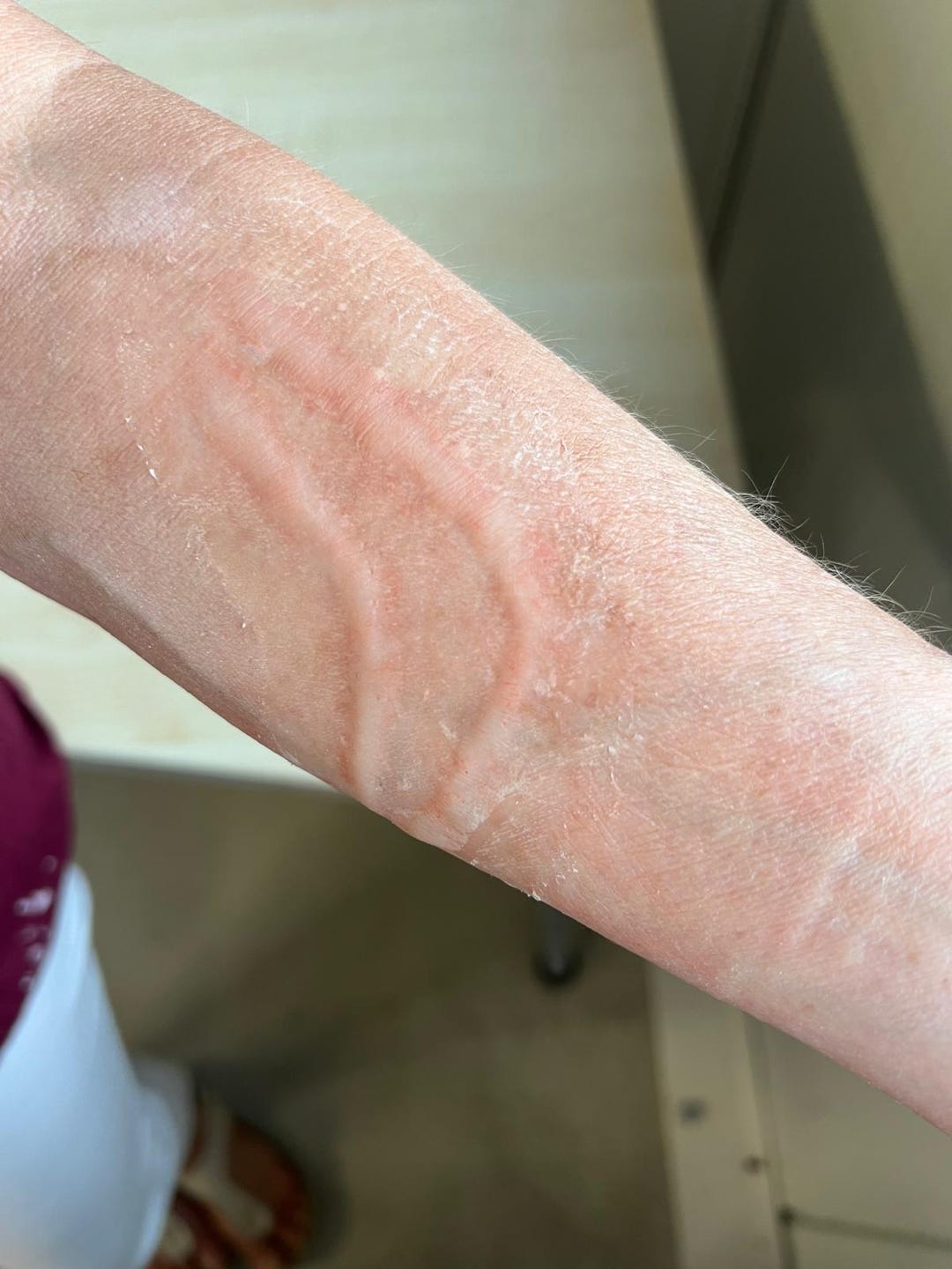 Realistic Silicone Keloid Scar – Handmade SFX Prosthetic for Halloween ...