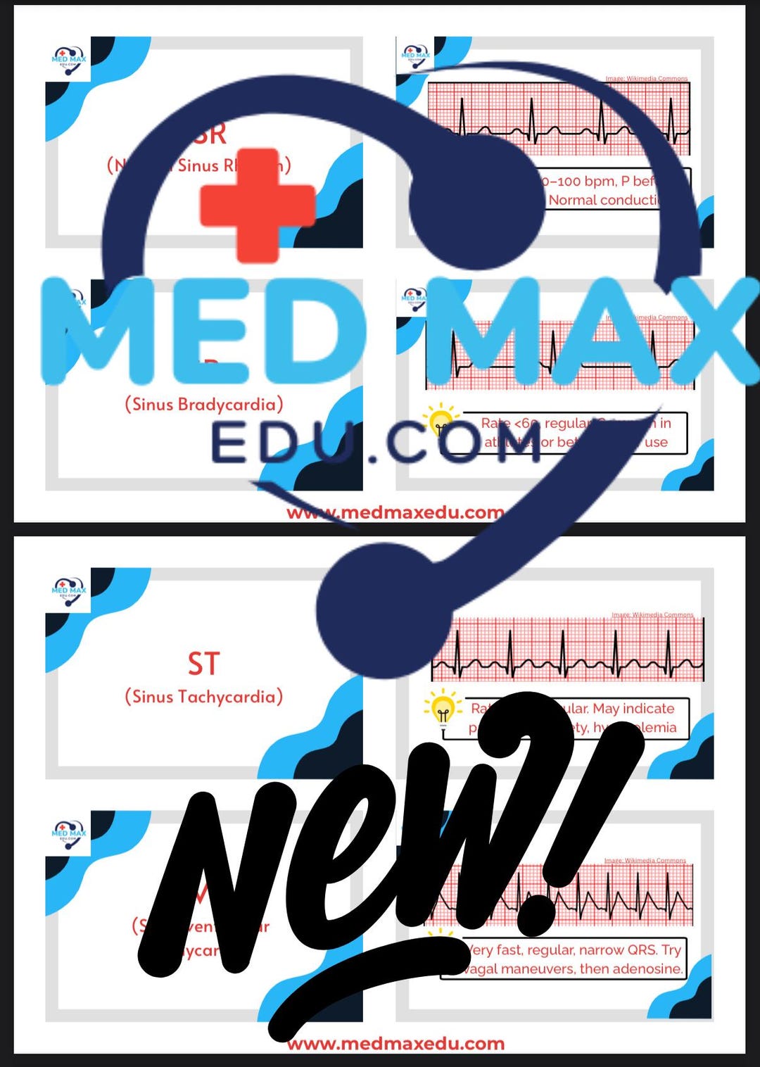 EKG Rhythm Flashcards for Nurses & Emts: Printable Study Set (digital ...