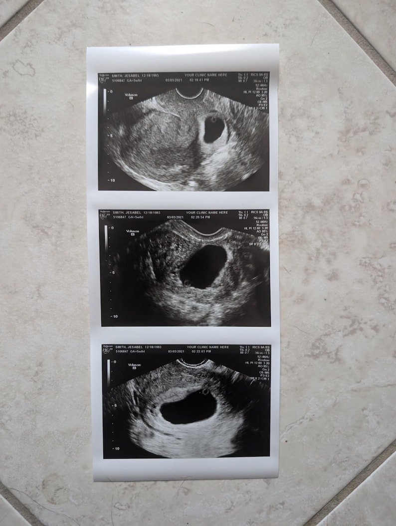 Pregnancy Keepsake - Your Ultrasound Image Print Outs on REAL MEDICAL ...