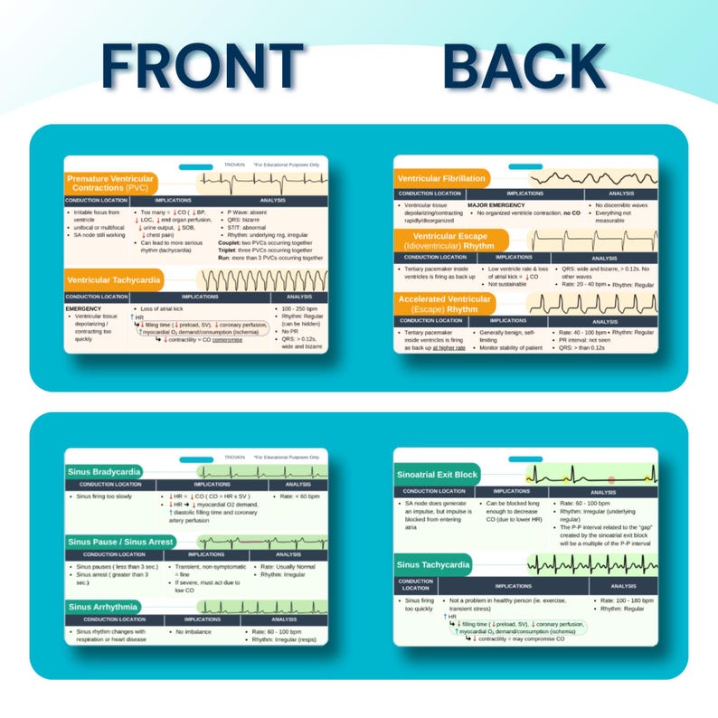 EKG Rhythm Interpretation Cards: Critical Explanations to Identify ...