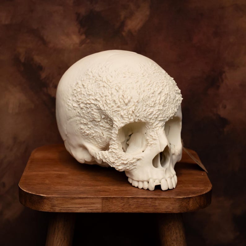 Life Size Human Skull With Bone Cancer Realistic Replica Rare Pathology ...