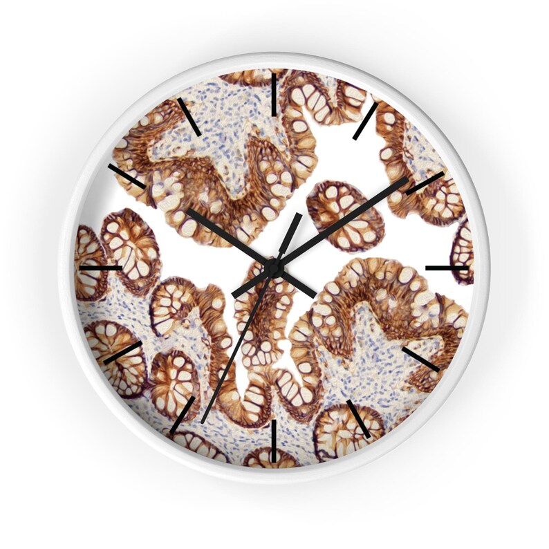Histology Wall Clock, Pathology Stain Colon Cancer, Medical Lab Tech ...