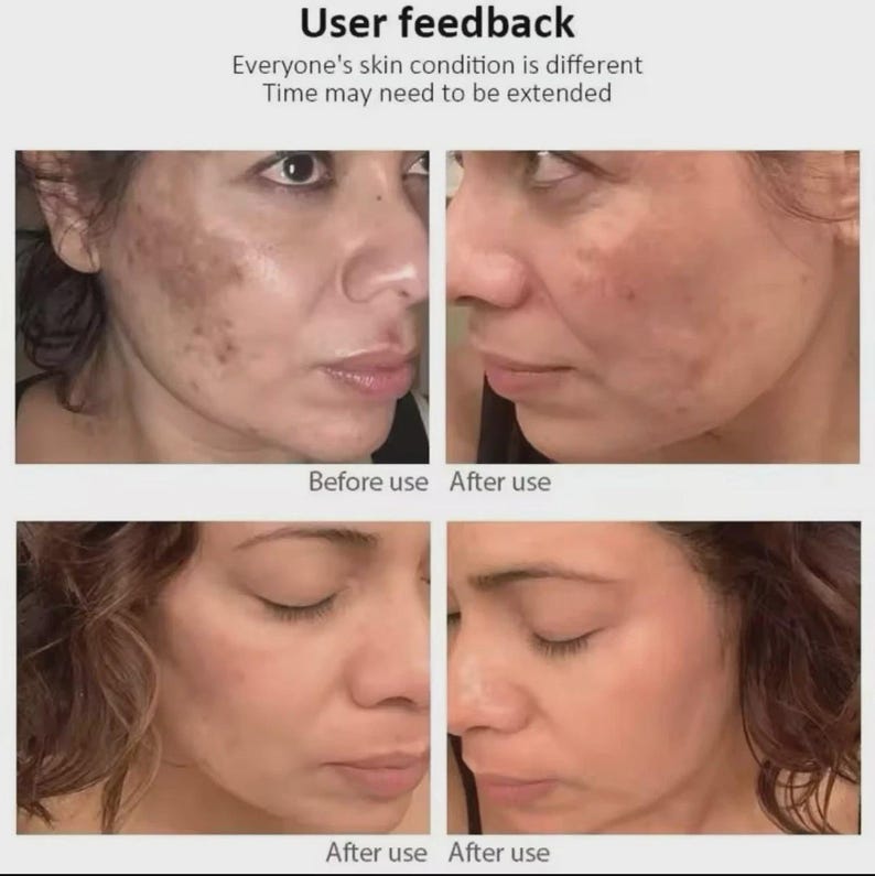 Skin Renewal Face Cream, Melasma Cream, Pigmentation Removal Cream ...