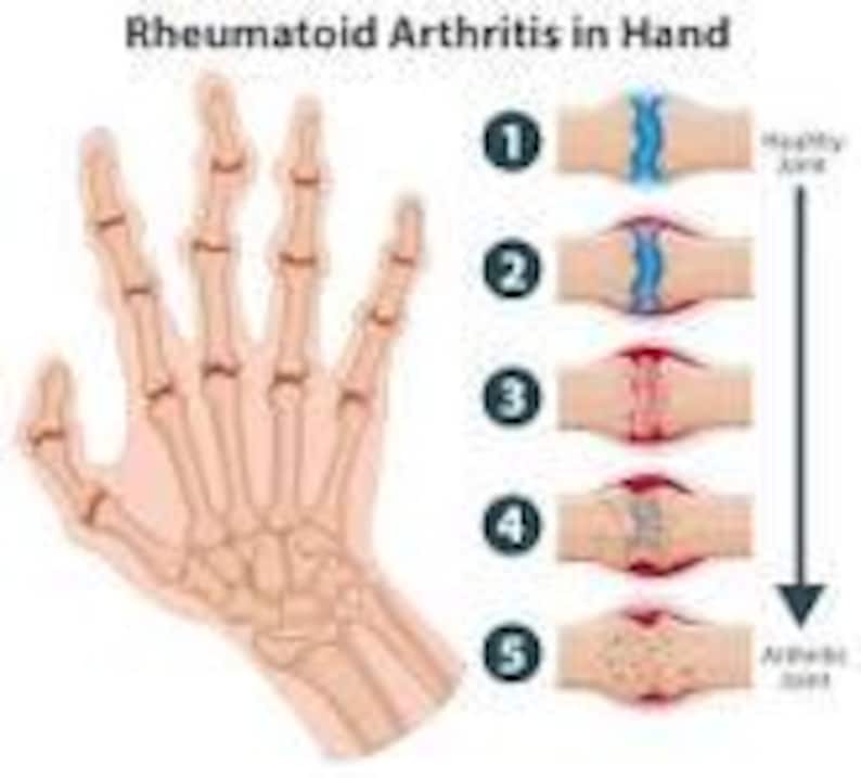 Spiral Full Finger Gold, Adjustable MCP Ring Splint, Finger Splint for ...