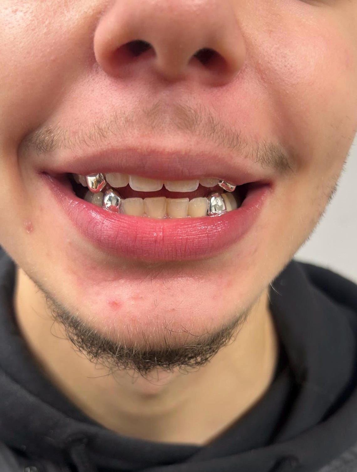 4 Sterling Silver 925 Caps Custom Made Grillz Any Teeth FREE Mould Kit ...