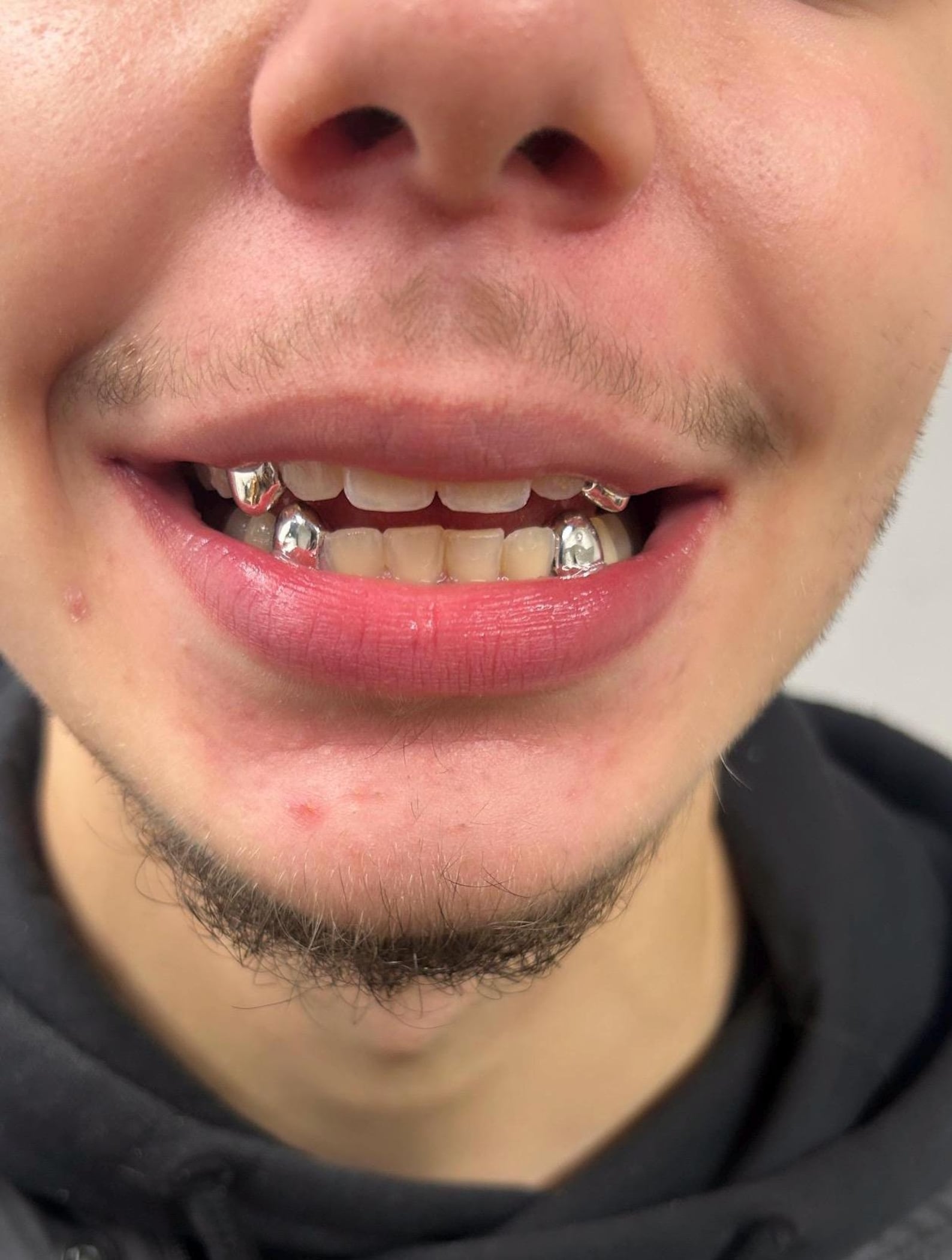 4 Sterling Silver 925 Caps Custom Made Grillz Any Teeth FREE Mould Kit ...