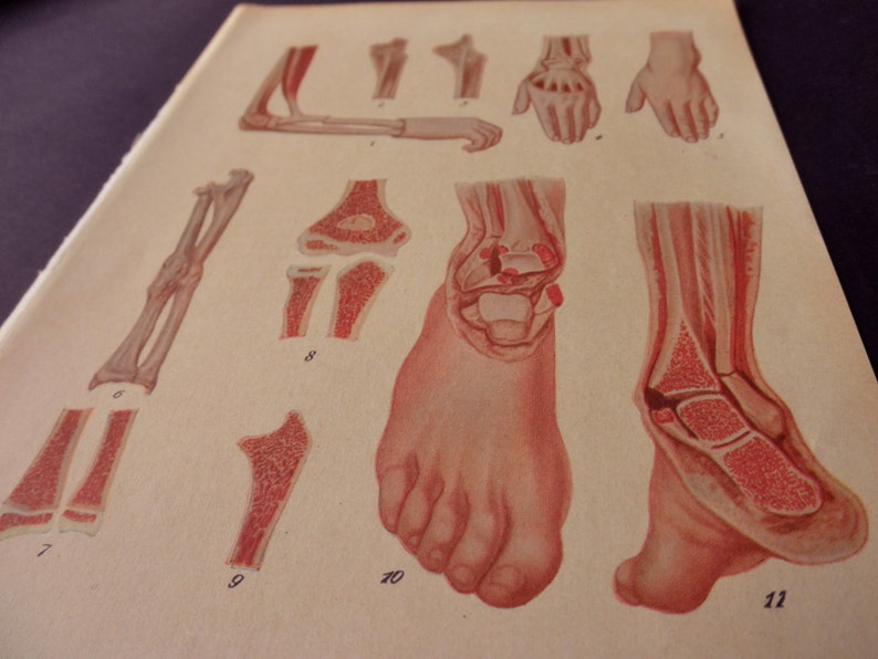 Original Page 1916 Color MEDICAL CHART From Antique Medical - Etsy