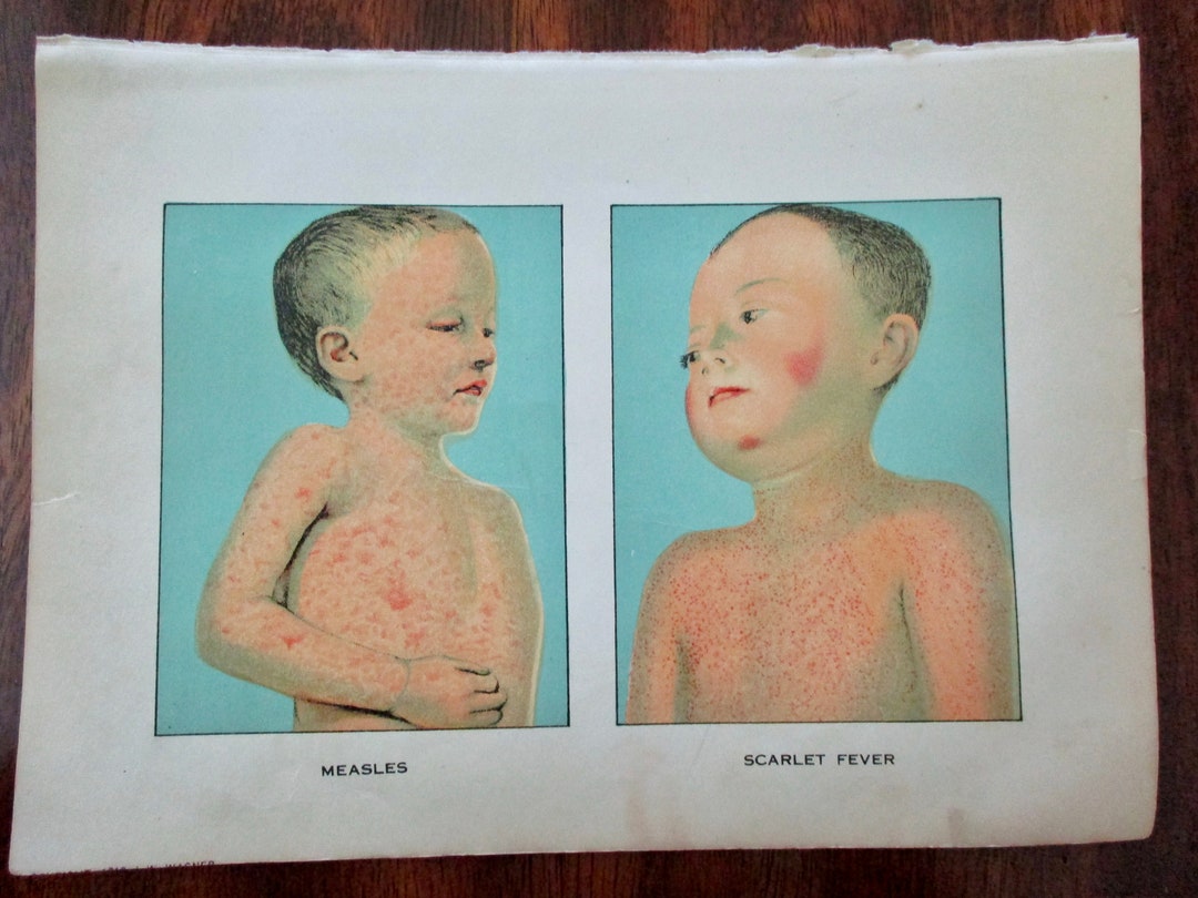 Measles, Scarlet Fever Original Page : Not a Copy, 1912 Color MEDICAL ...