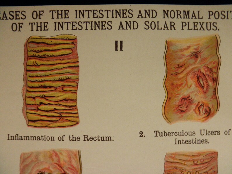 Original 1898 Color Litho MEDICAL Page From Antique Medical Book ...