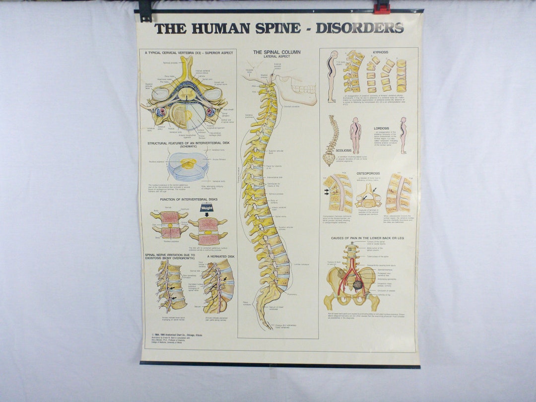 1986 Anatomical Chart Co / Spine Disorders / Wall Decor - Etsy