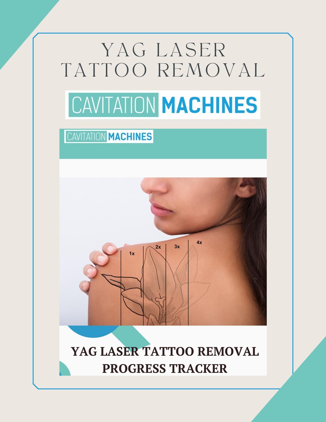 Shape Tactics YAG Laser Tattoo Removal Progress Tracker - Etsy